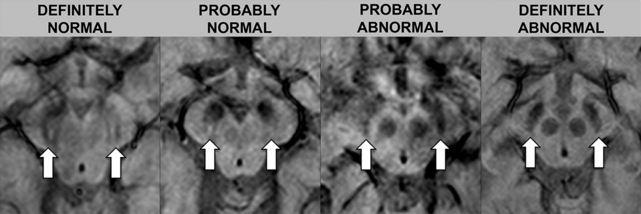 005-„swallow tail sign“ bei Parkinson – Martin Plattner